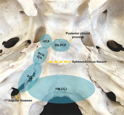 Posterior Clinoid Process